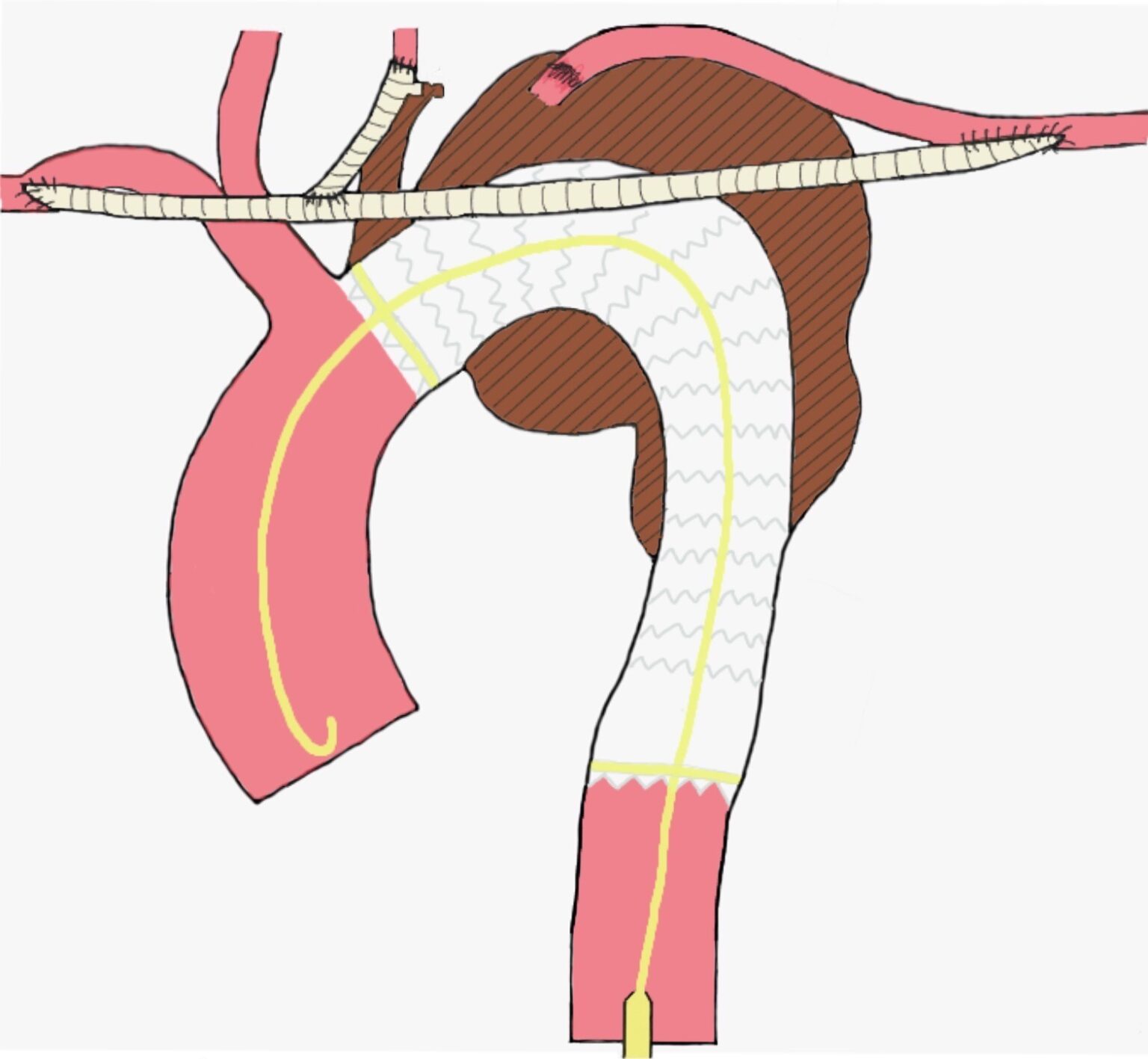 手術室看護師も分かりにくいデブランチTEVARってどんな手術？