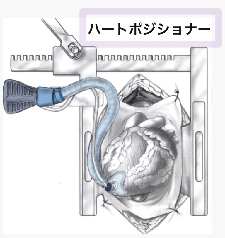 【手順】冠動脈バイパス術（CABG）の手術介助③