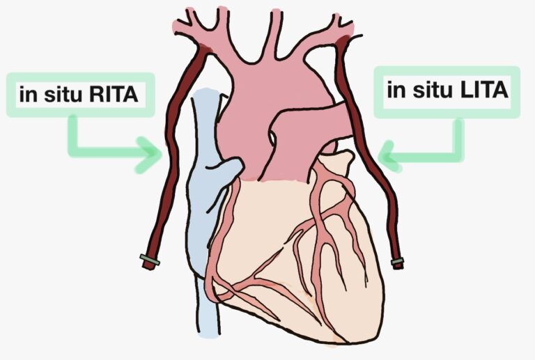 【よく使われる用語】冠動脈バイパス術（CABG）の手術介助④