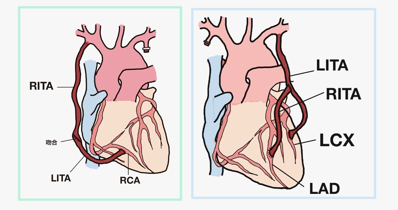 cabg 画像 – 冠 動脈 出血 – KPWLV